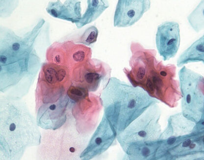 Liquid-based cytology testing | BD Cervical cancer