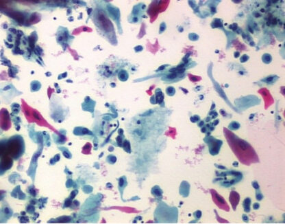 Liquid-based cytology testing | BD Cervical cancer